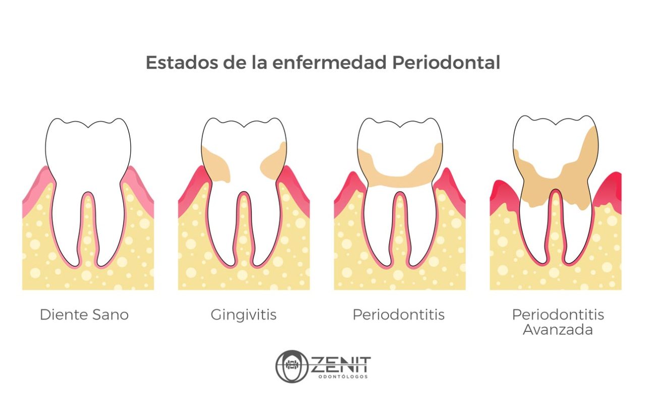 Sarro en los dientes: Tratamiento y prevención | Zenit Odontólogos