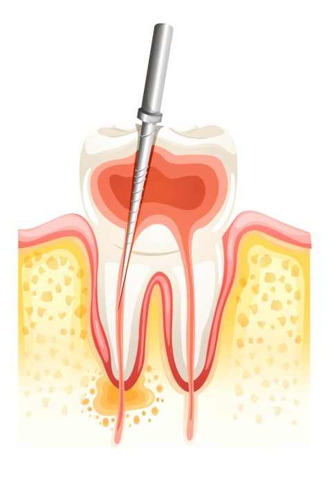 Diferencias Entre Empaste Y Endodoncia: Lo Que Debes Saber – DNVD
